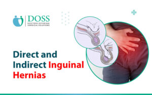 Direct vs. Indirect Inguinal Hernias: Causes, Symptoms, Treatment